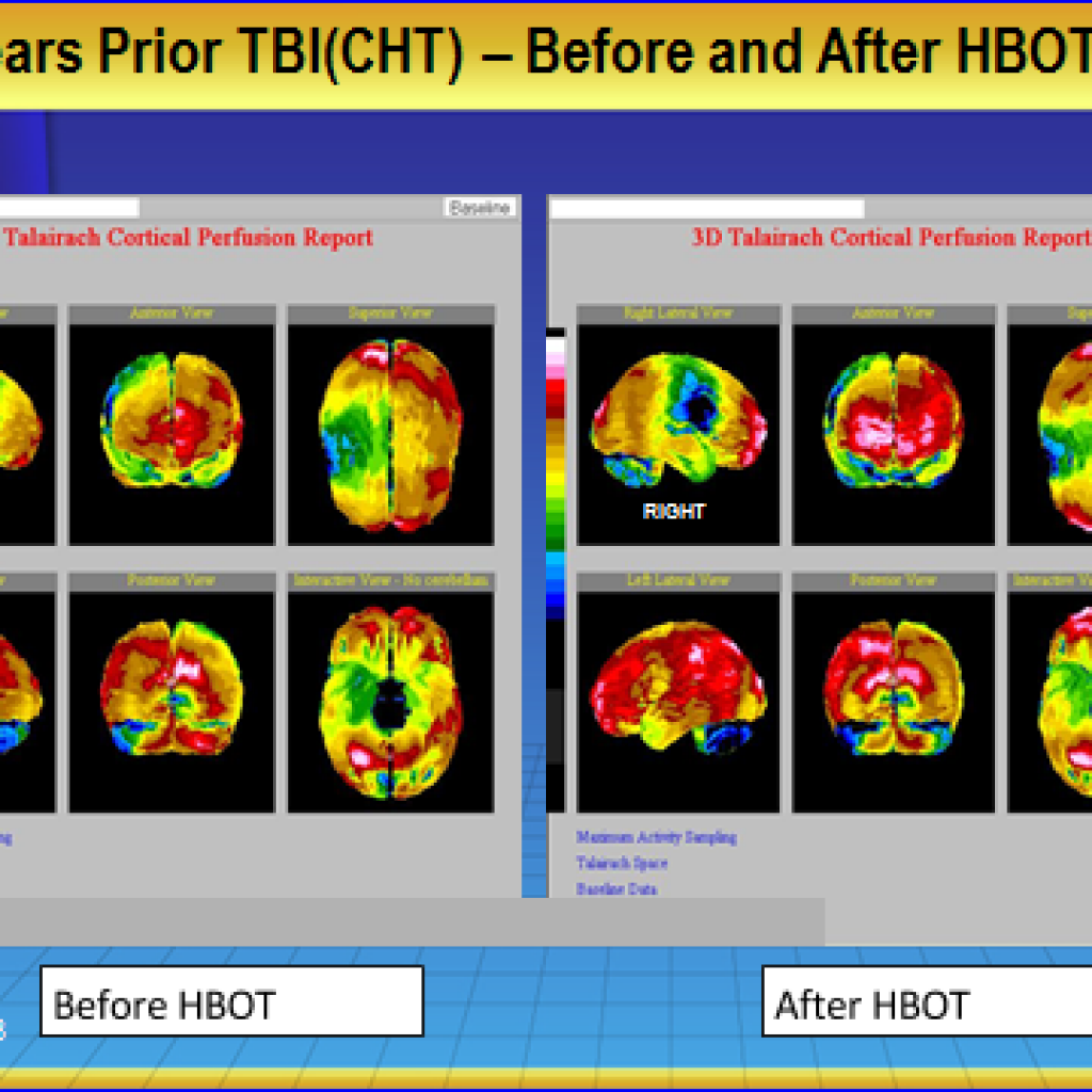 Hyperbaric Oxygen Treatment - Neuro-Laser Foundation