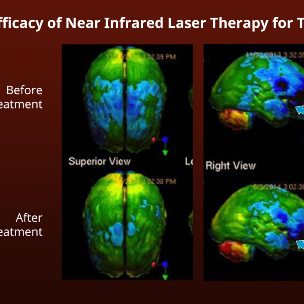 What is NILT? - Neuro-Laser Foundation