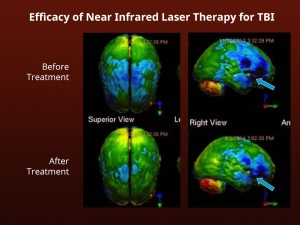 What is NILT? - Neuro-Laser Foundation