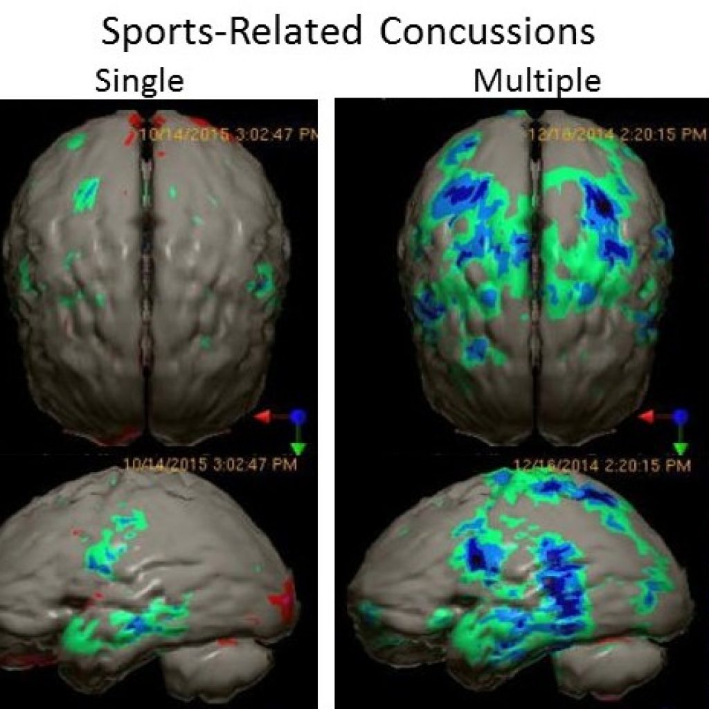 Rebuttal – Concussion Risks in Youth Sports Hardly Minimal - Neuro ...