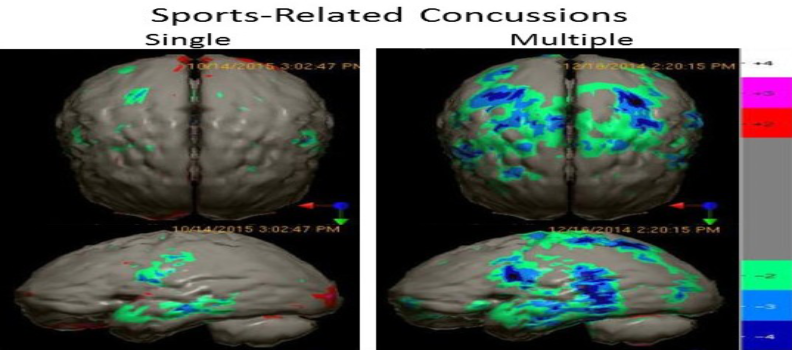 Tag: sports concussions - Neuro-Laser Foundation